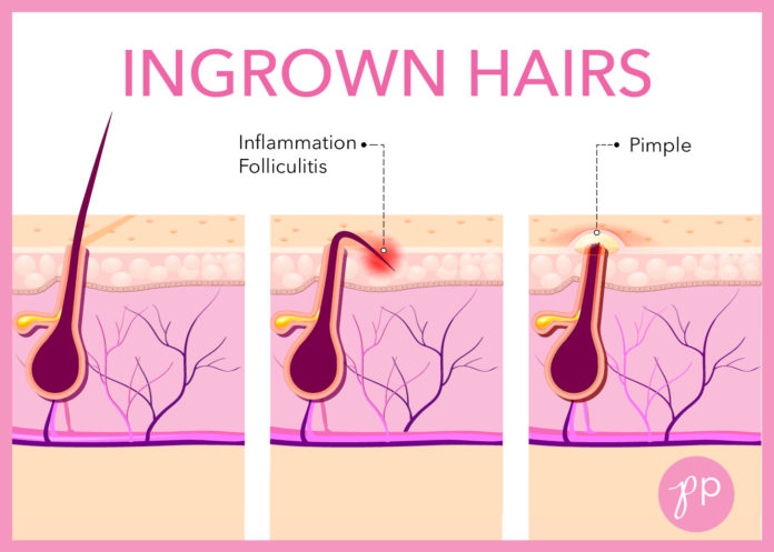 Ingrown Hairs - Preventing Future Problems
